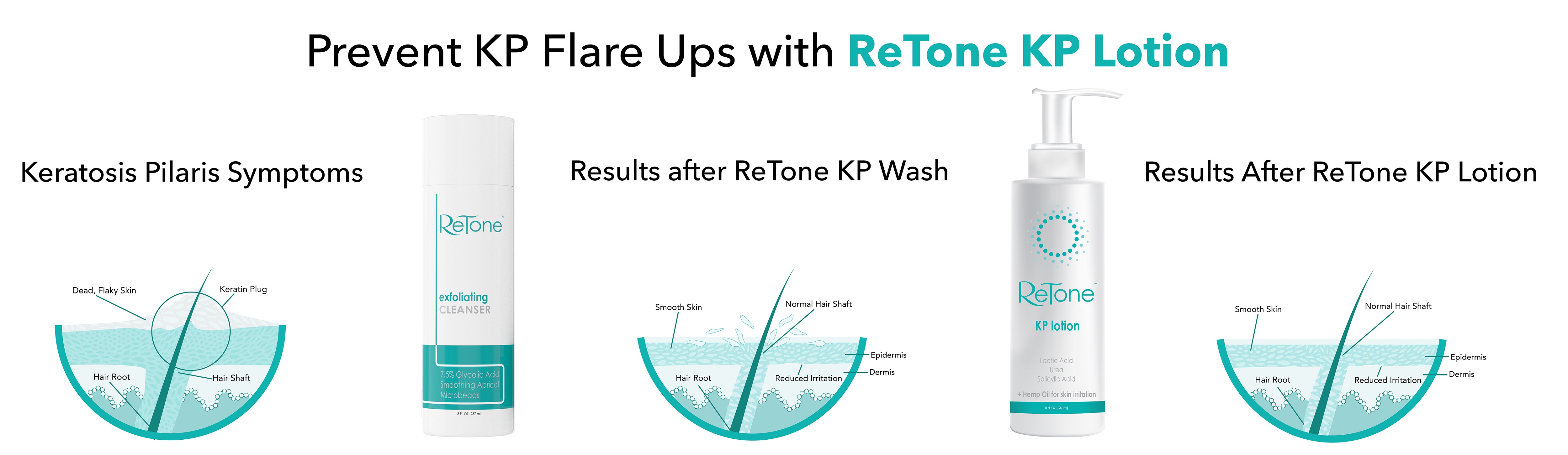 How to Treat Keratosis Pilaris Symptoms | ReTone